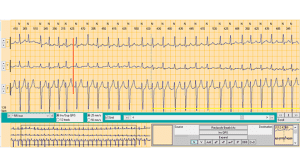 SpiderView Holter Recorder and Synecope Software – inmed.com.au